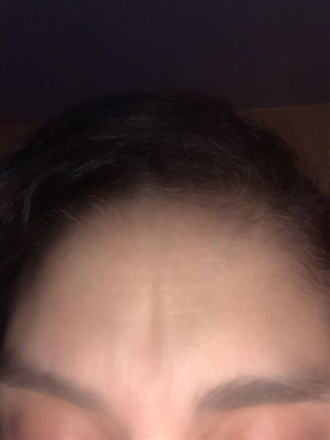 Does This Look Like Linear Scleroderma I Have Systemic Scleroderma Sine And I Have This Line On
