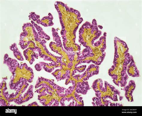 Brain Tumour Light Micrograph LM Of A Section Of An Affected Human