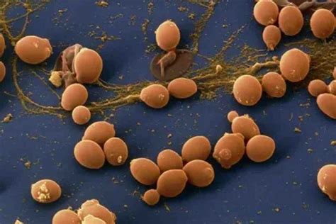 Причины и симптомы кандидозного баланопостита — Journal Ua