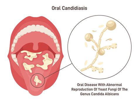 Oral Candidiasis Oral Yeast Infection Of Fungal Candida Albicans