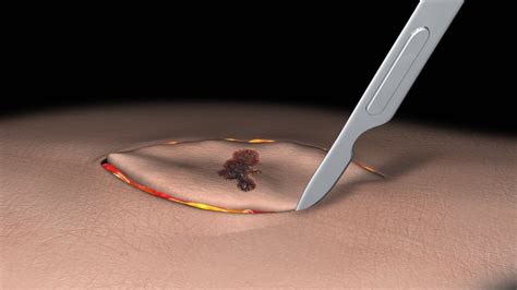 Excisional Biopsy Youtube
