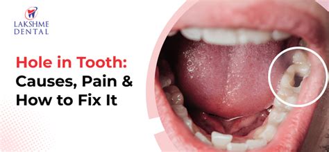10 Home Remedies For A Sore Tongue