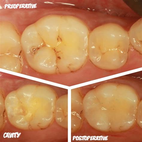 Fathy Sharaf On Linkedin Class I Compsite Restoration