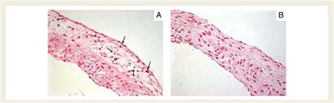 Aortic Valve Leaflet Calcification With Recombinant Apolipoprotein A I Download Scientific