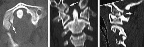 Occipital Condyle Fracture Type 3