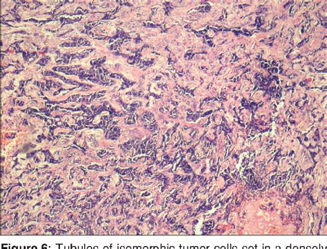 Figure 1 From Adenoid Cystic Carcinoma Of Palate A Case Report And