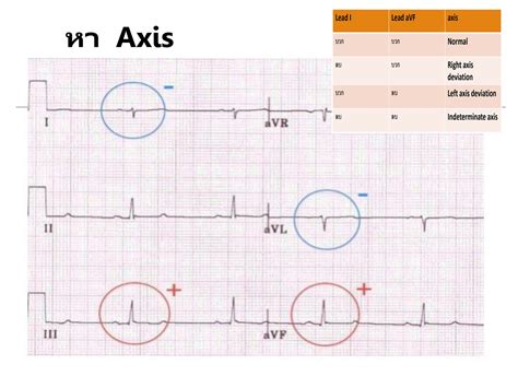 Basic Ekg For Nurse Porntana22 Page 70 Flip Pdf Online Pubhtml5