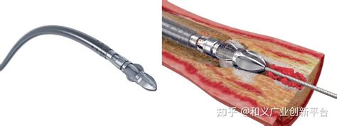 外周血管介入器械2——介绍3种外周动脉疾病介入治疗器械 知乎