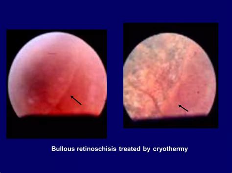 Retinoschisis And Retinal Detachment Ppt