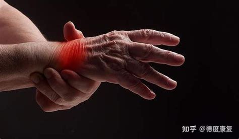 一种手腕骨折康复的训练方法 知乎