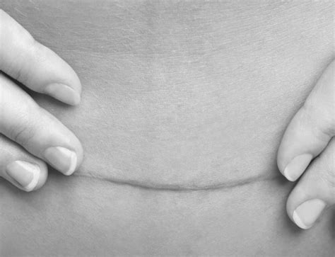 Know More About Fleur De Lis Abdominoplasty Grand Genesis Plastic Surgery