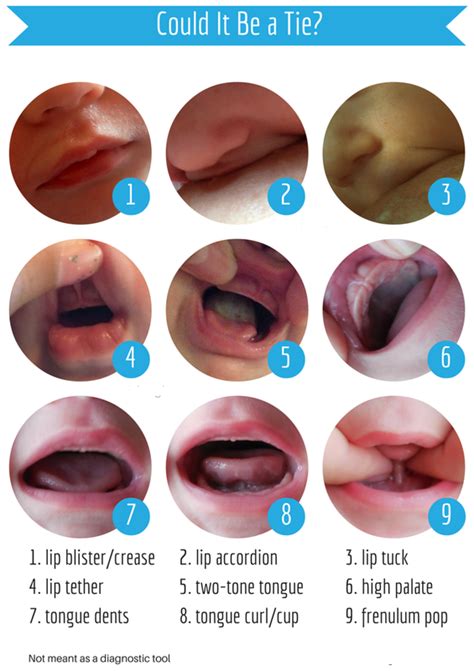 Frenulum Tongue