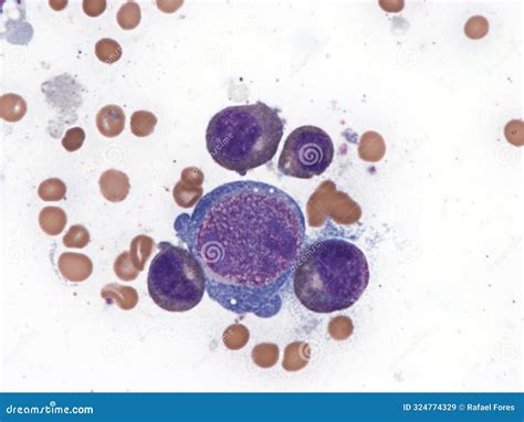 Parvovirus Infection Bone Marrow Stock Image Image Of Erythroblastopenia Giant