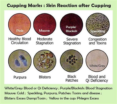 Cupping Therapy A Healing Point Acu Center