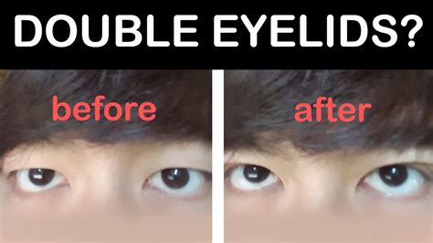 Double Eyelid Surgery My Thoughts On Monolids Youtube