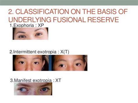 Exodeviations