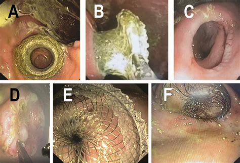Steps In The Fully Endoscopic Jejunal Bypass With Duodenal Exclusion Download Scientific
