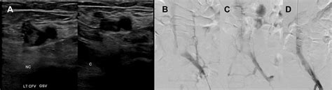 A Ultrasound Demonstrates An Acute Deep Venous Thrombosis Dvt In