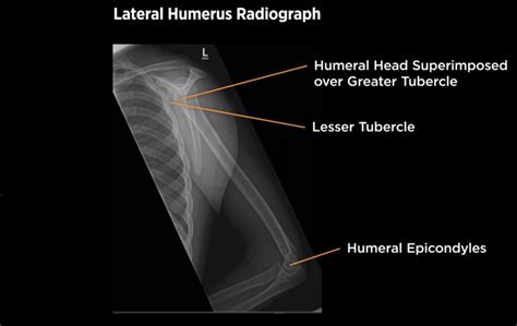 Optimal Lateral Humerus X Rays Positioning The Radiographer S Guide Hsin Film