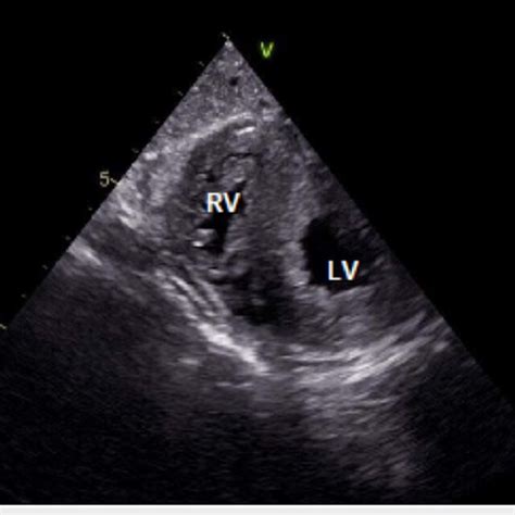 Technetium Pyrophosphate Scan Revealing Radioactive Pharmaceutical Download Scientific Diagram