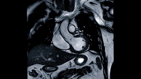 Resonancia Magnética Cardíaca Del Corazón O Resonancia Magnética