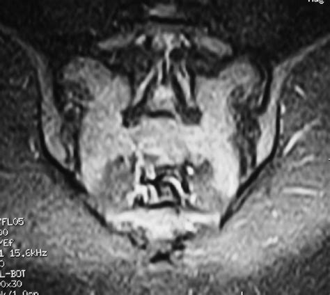 A 31 Years Old Woman With As And Bilateral Sacroiliitis Laboratory