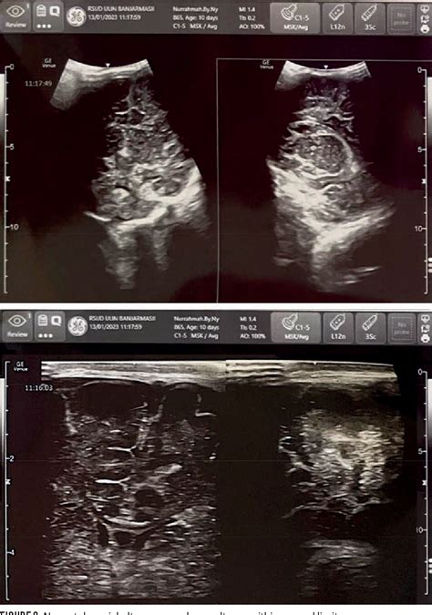 Figure 1 From Acute Encephalopathy Bilirubin In The First Week Of Life A Case Of G6pd Deficient