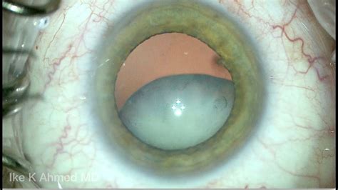 Traumatic Cataract