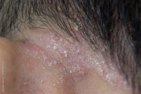 Scalp Fungal Infection That Causes Skin Disease At The Head Skin On The Scalp To Flake Dandruff