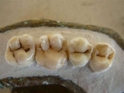 Class Ii Cavity Preparation For Amalgam Pptx Oral Care Personal Care