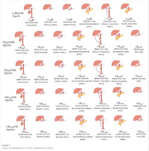 Figure 2 From A Rare Hepatic Artery Variant Reporting And A New
