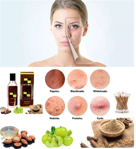 Medicated Lotion To Clear Pimples And Blackheads All Natural Nut Grass