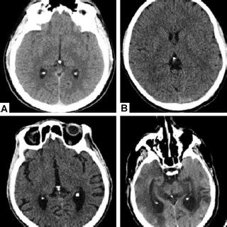A A Year Old Male With Pineal And Choroid Plexus Calcification B A Download Scientific