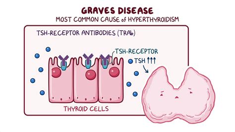 Graves Disease Clinical Sciences Osmosis Video Library