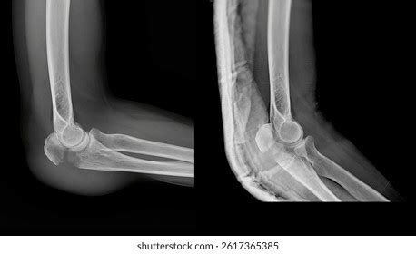 X Ray Image Showing Fracture Olecranon Process Stock Illustration 2617365385 Shutterstock