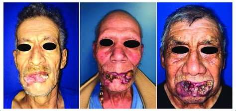 Patients Diagnosed With Clinical Stage Iii Epidermoid Cancer Download Scientific Diagram