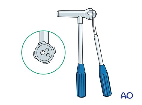Elastic Nailing For Simple Transverse Tibial Fracture