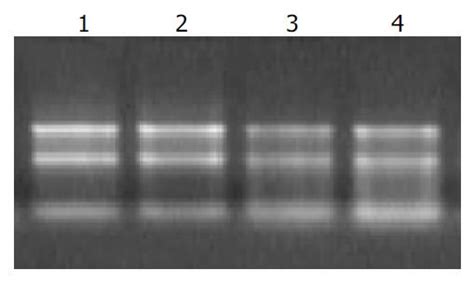 Differentially Expressed Genes Between Solitary Large Hepatocellular Carcinoma And Nodular