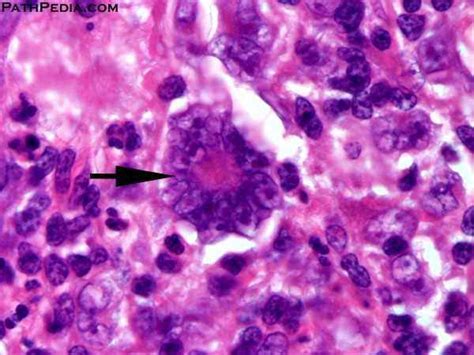 Is It Safe To Have Sex When One Has Detected Hodgkin Lymphoma Quora