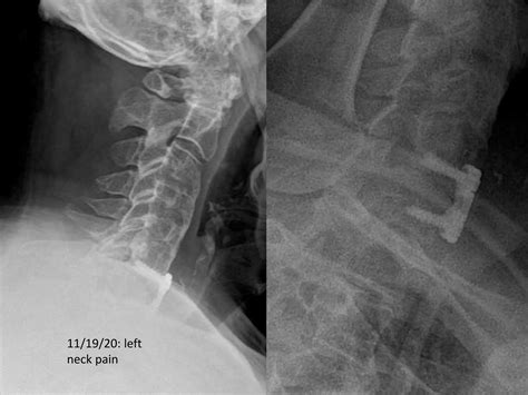 Pseudarthrosis Cervical Spine Ppt