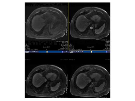 Radioembolization Induced Liver Disease A Brief And Limited
