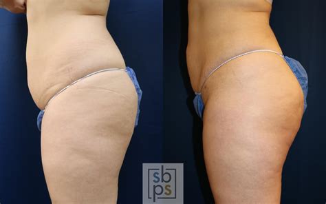 Buttock Augmentation Before And After Pictures Case 687 Los Angeles