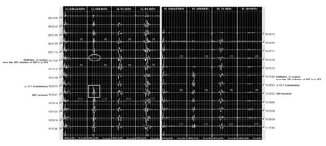 Intraoperative Neurophysiological Monitoring Mep The Mep In Left Apb