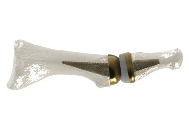 Addup And Anatomic Implants Collaborate On Fda Submission For 3d