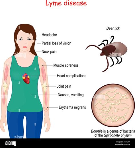 Lyme Disease Tick Vector At Leah Grasby Blog