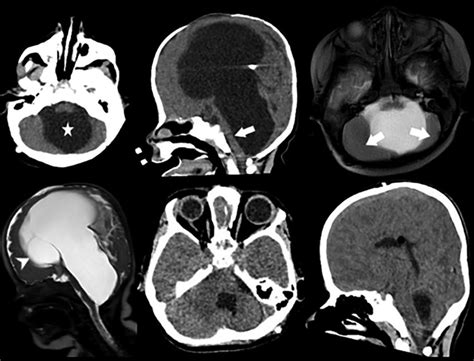 Axial And Sagittal Brain Ct Images Without Contrast A B And Axial Download Scientific
