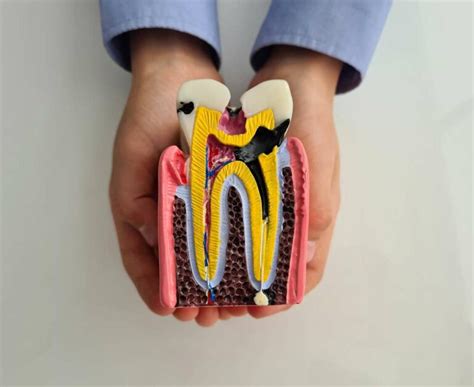 La Caries Dental Síntomas Causas Prevención Y Tratamientos