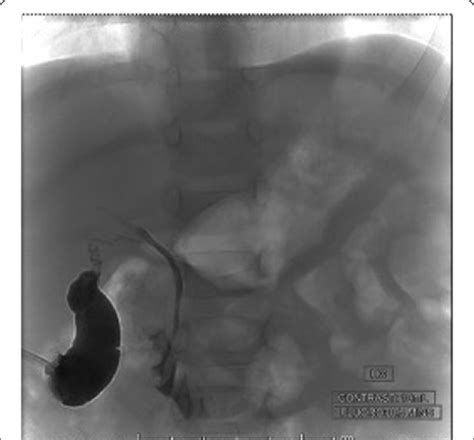 Eight Weeks Post Op Cholangiogram Through Cholecystostomy Demonstrating