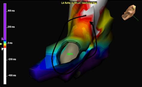 Isochronal Map In The Right Anterior Oblique View Demonstrates A Left