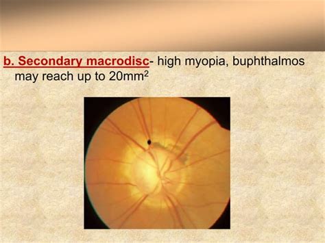 Anatomy And Physiology Of Optic Nerve Dr Prabhatdevkota Pptx Eye And